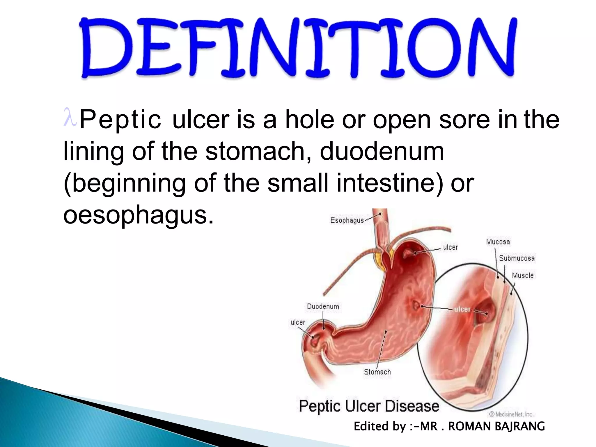 Peptic Ulcer Ppt Ppt