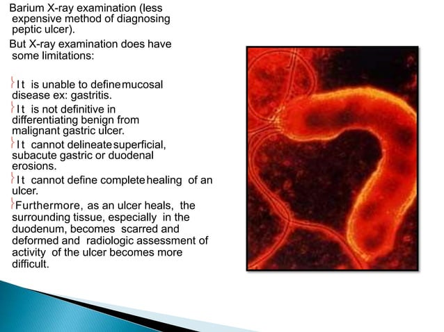 Peptic ulcer ppt | PPTX | Digestive Disorders | Diseases and Conditions