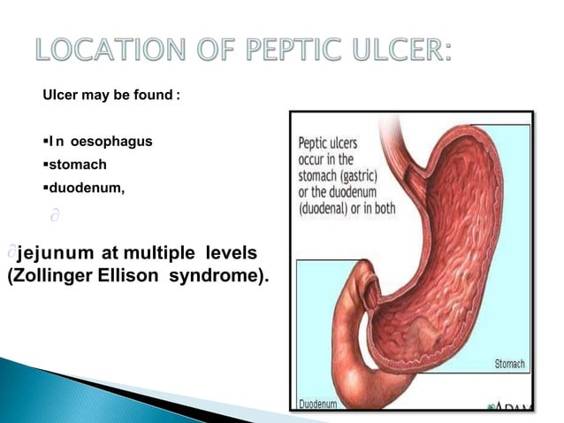 Peptic ulcer ppt | PPTX | Digestive Disorders | Diseases and Conditions