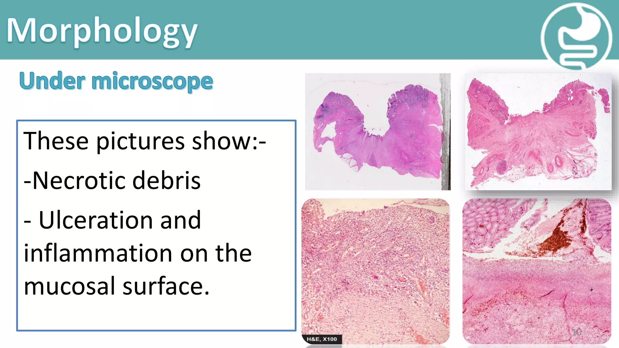 Peptic ulcer rayan saleh al humaid - 1 | PDF