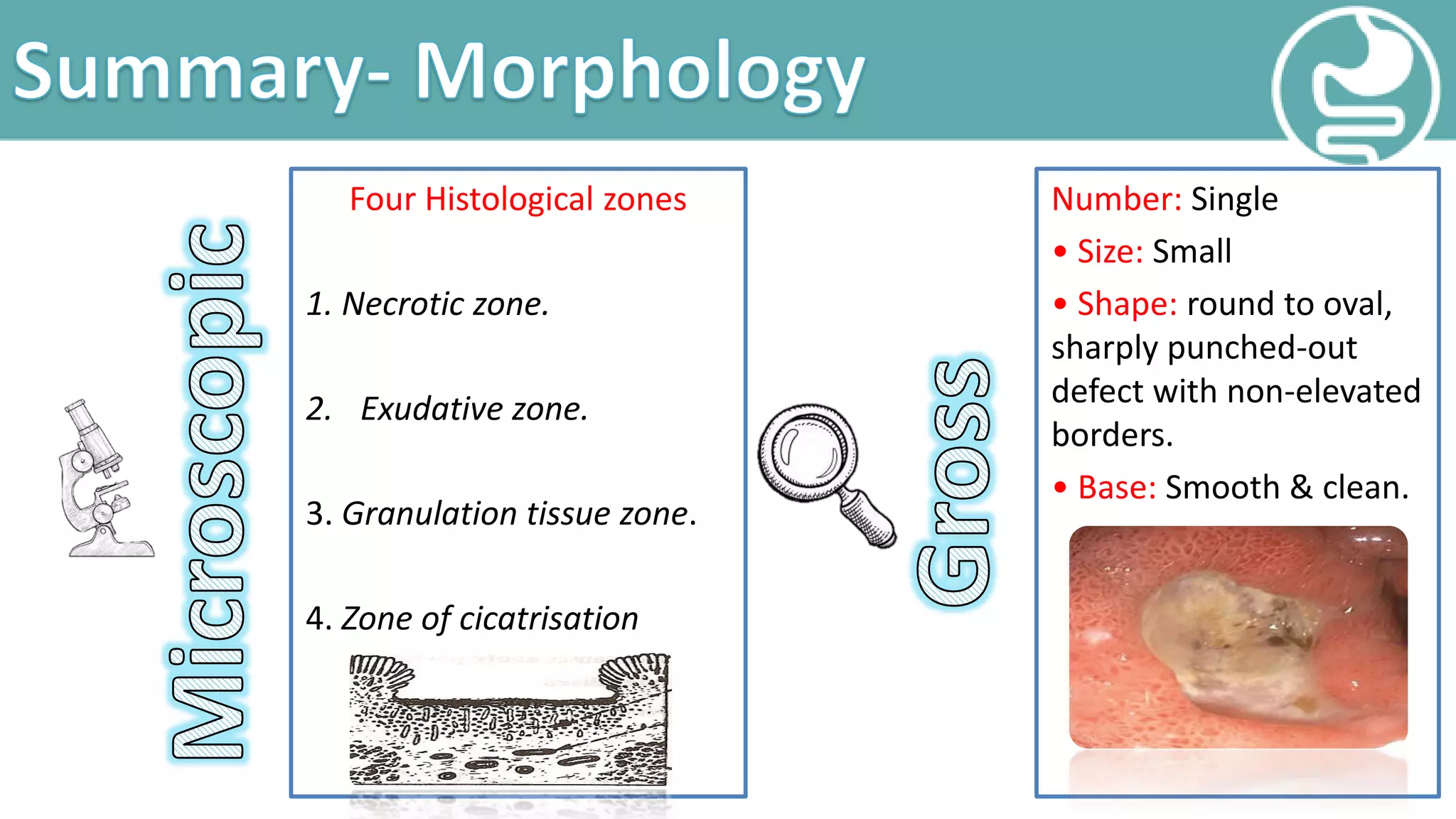 Peptic ulcer rayan saleh al humaid - 1 | PDF