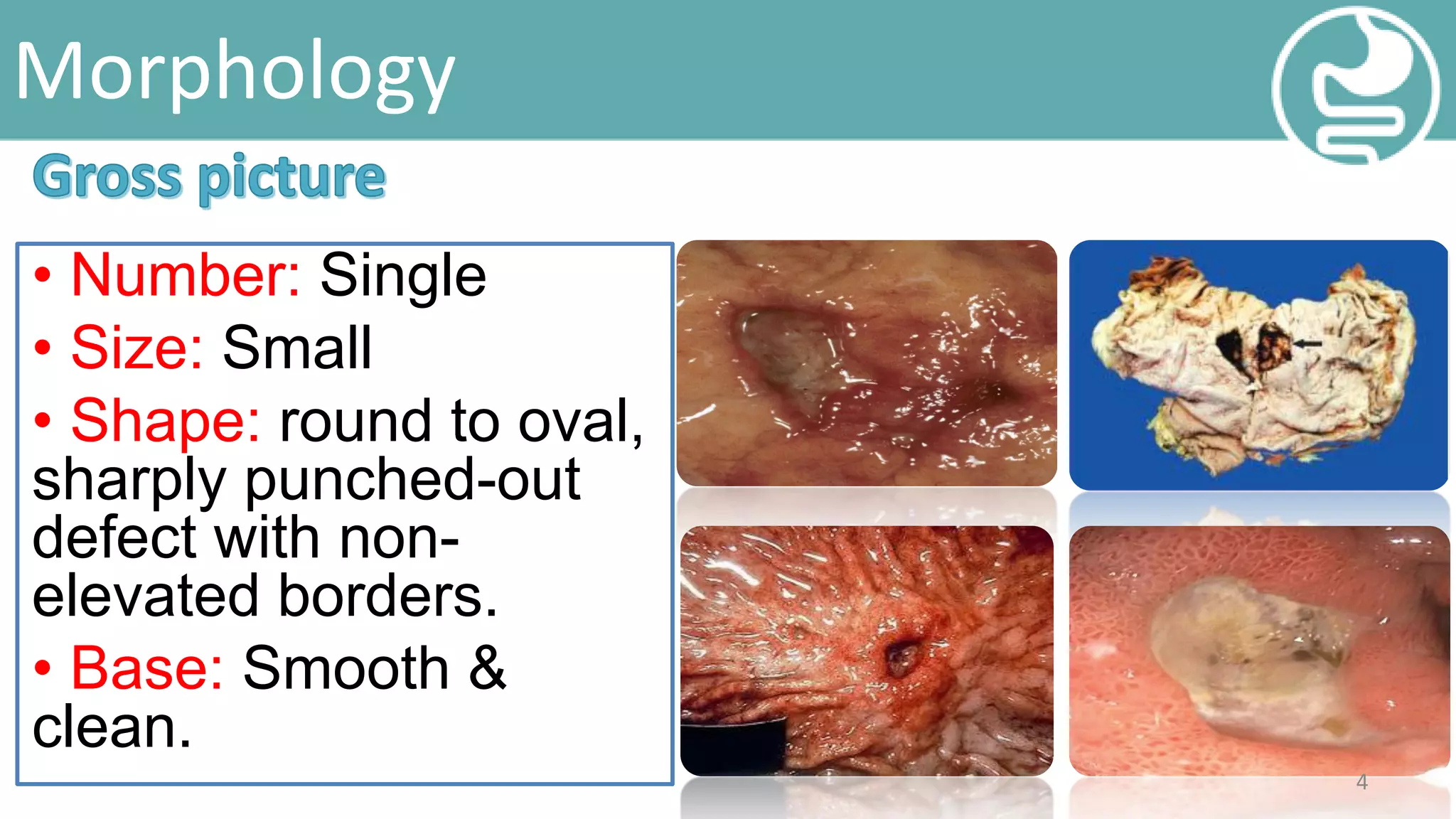 Peptic ulcer rayan saleh al humaid - 1 | PDF