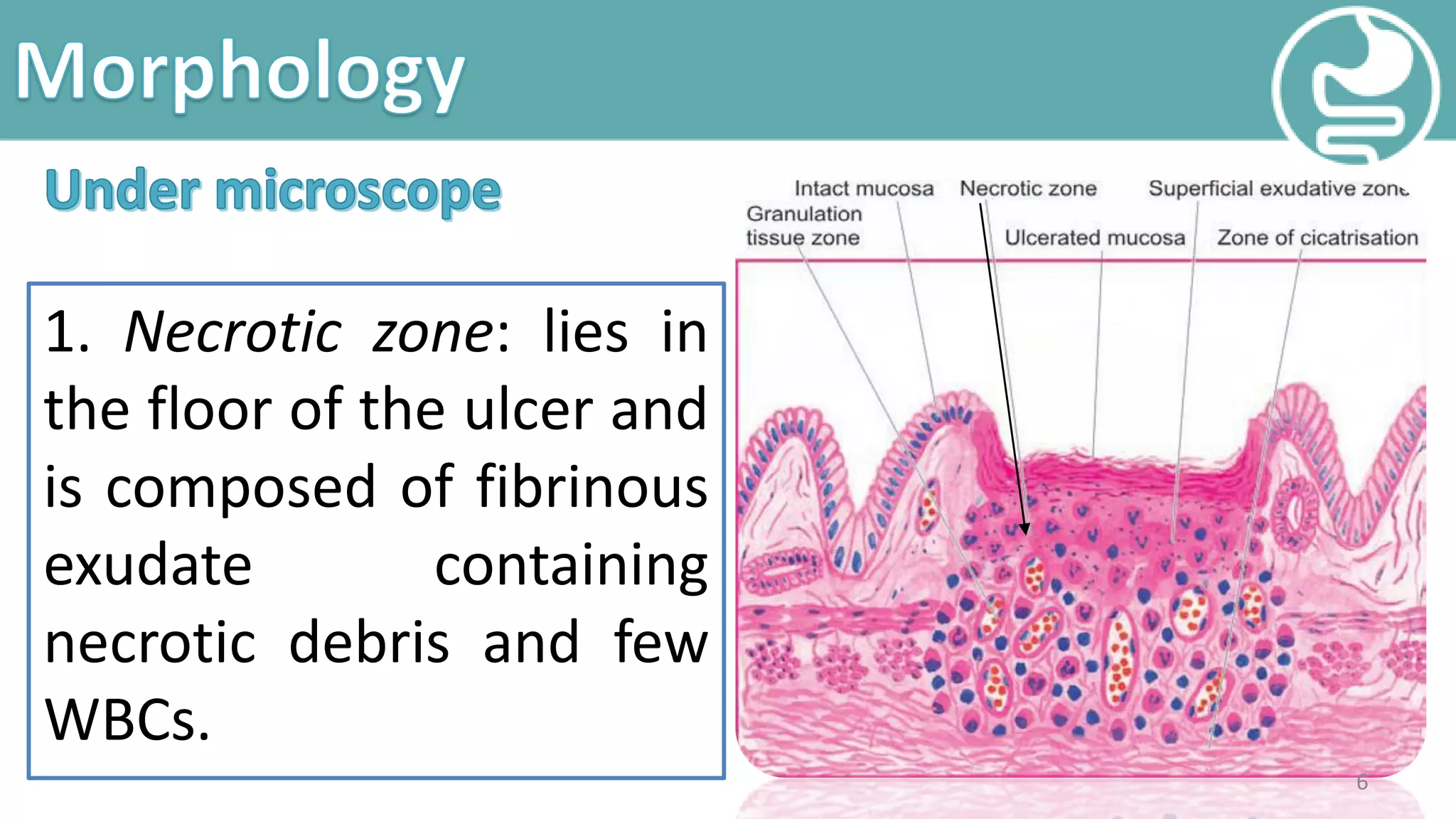 Peptic ulcer rayan saleh al humaid - 1 | PDF