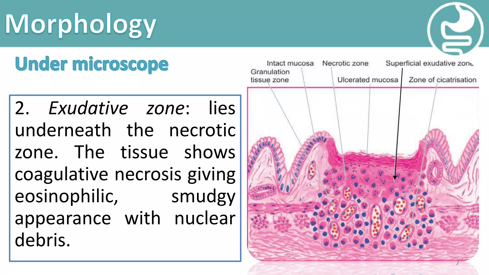 Peptic ulcer rayan saleh al humaid - 1 | PDF