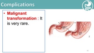 Peptic ulcer rayan saleh al humaid - 1 | PPT