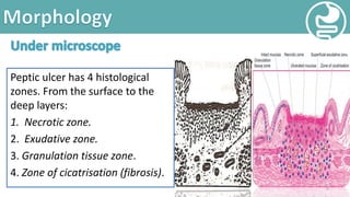 Peptic ulcer rayan saleh al humaid - 1 | PPT