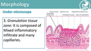 Peptic ulcer rayan saleh al humaid - 1 | PPT