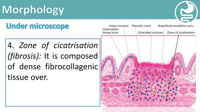 Peptic ulcer rayan saleh al humaid - 1 | PPT