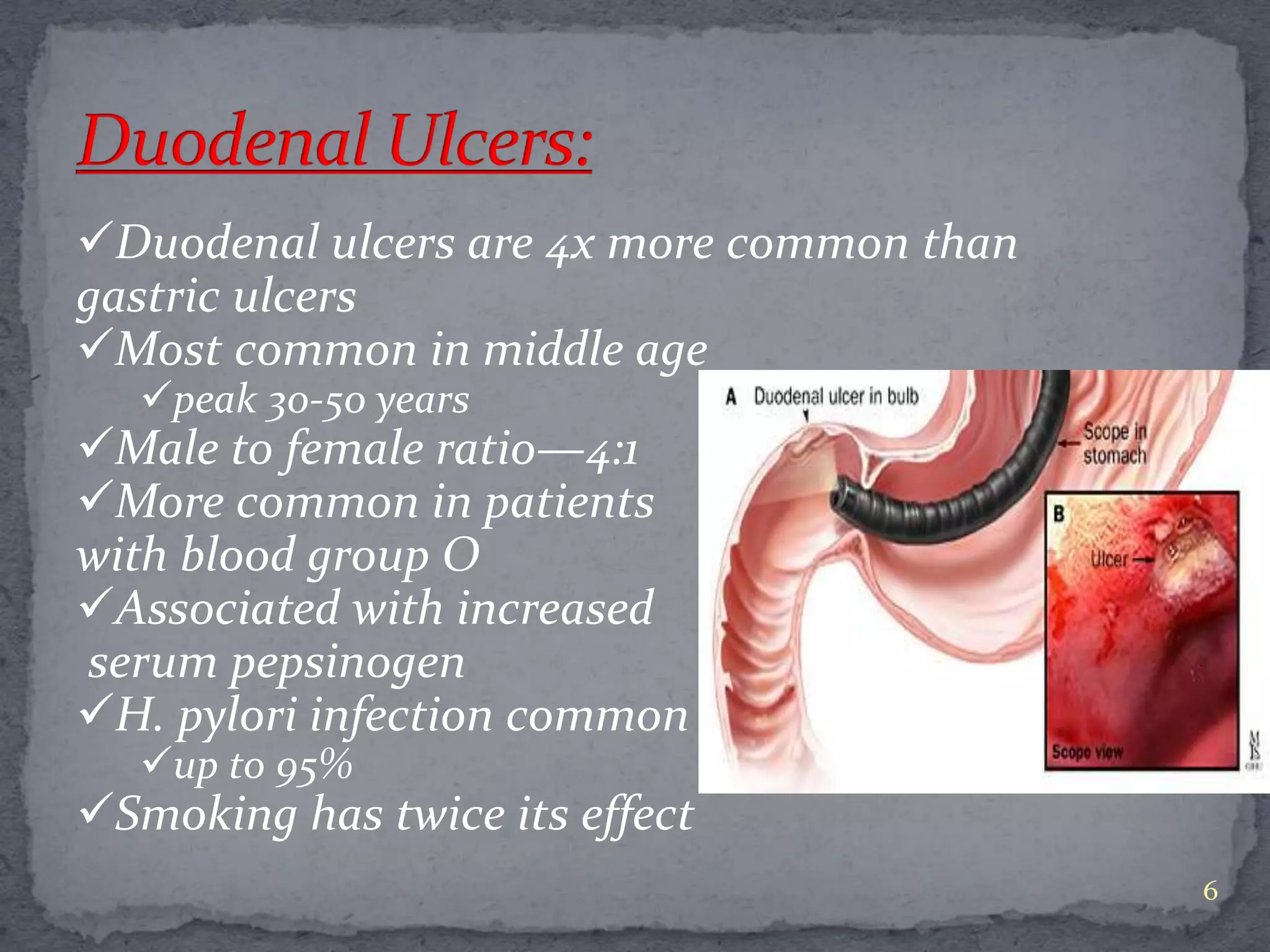 Peptic ulcers | PPTX