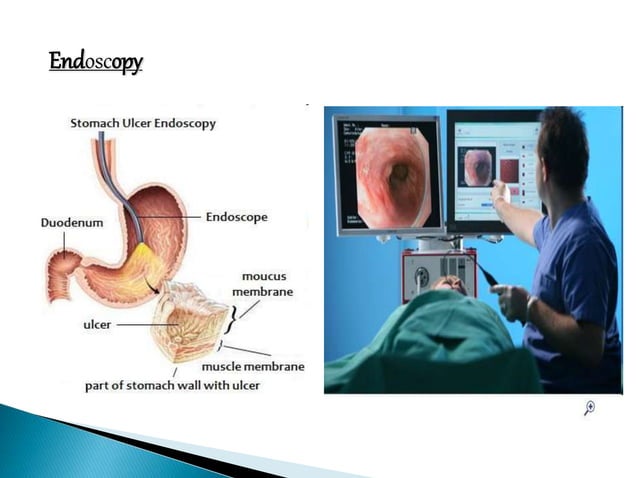 Peptic Ulcers Pathophysiology | PPT