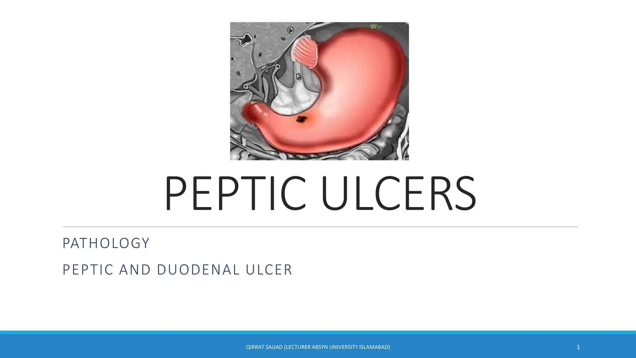 PEPTIC ULCERS (1).pdf PEPTIC ULCERS (1).pdfPEPTIC ULCERS (1).pdf