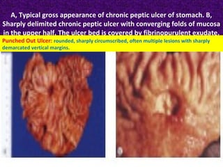 Peptic ulcer st f n | PPT