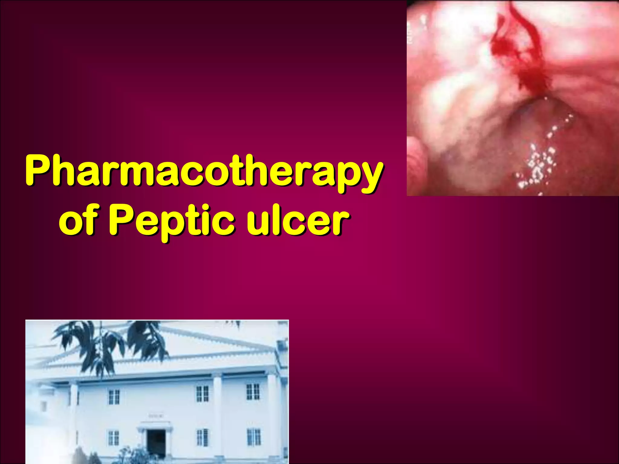 Peptic ulcer treatment | PPTX