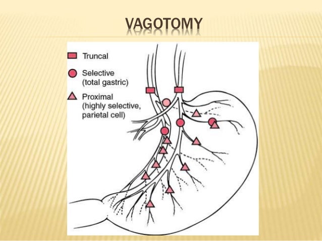 Peptic ulcer & upper gi bleeding