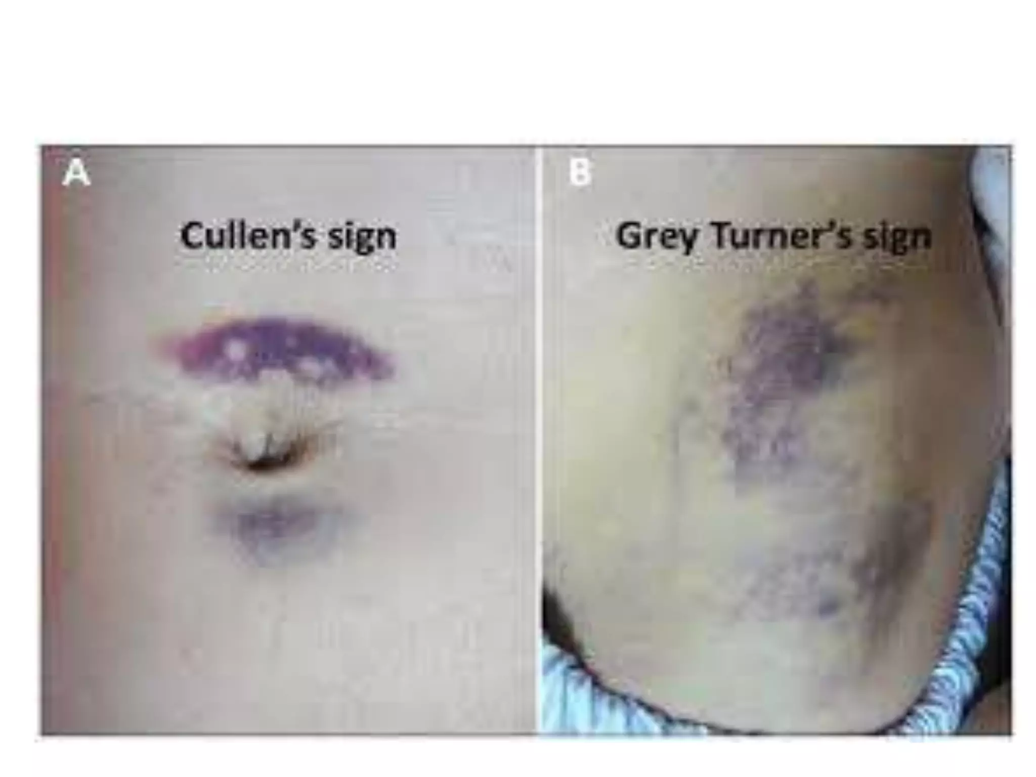 Per abdomen examination - Clinical Methods - Abdomen | PPTX