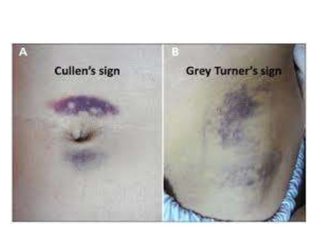 Per abdomen examination - Clinical Methods - Abdomen | PPTX