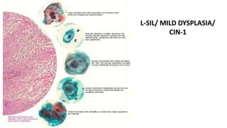 Peran Pemeriksaan Sitologi Pada Deteksi Dini Kanker Serviks.pptx