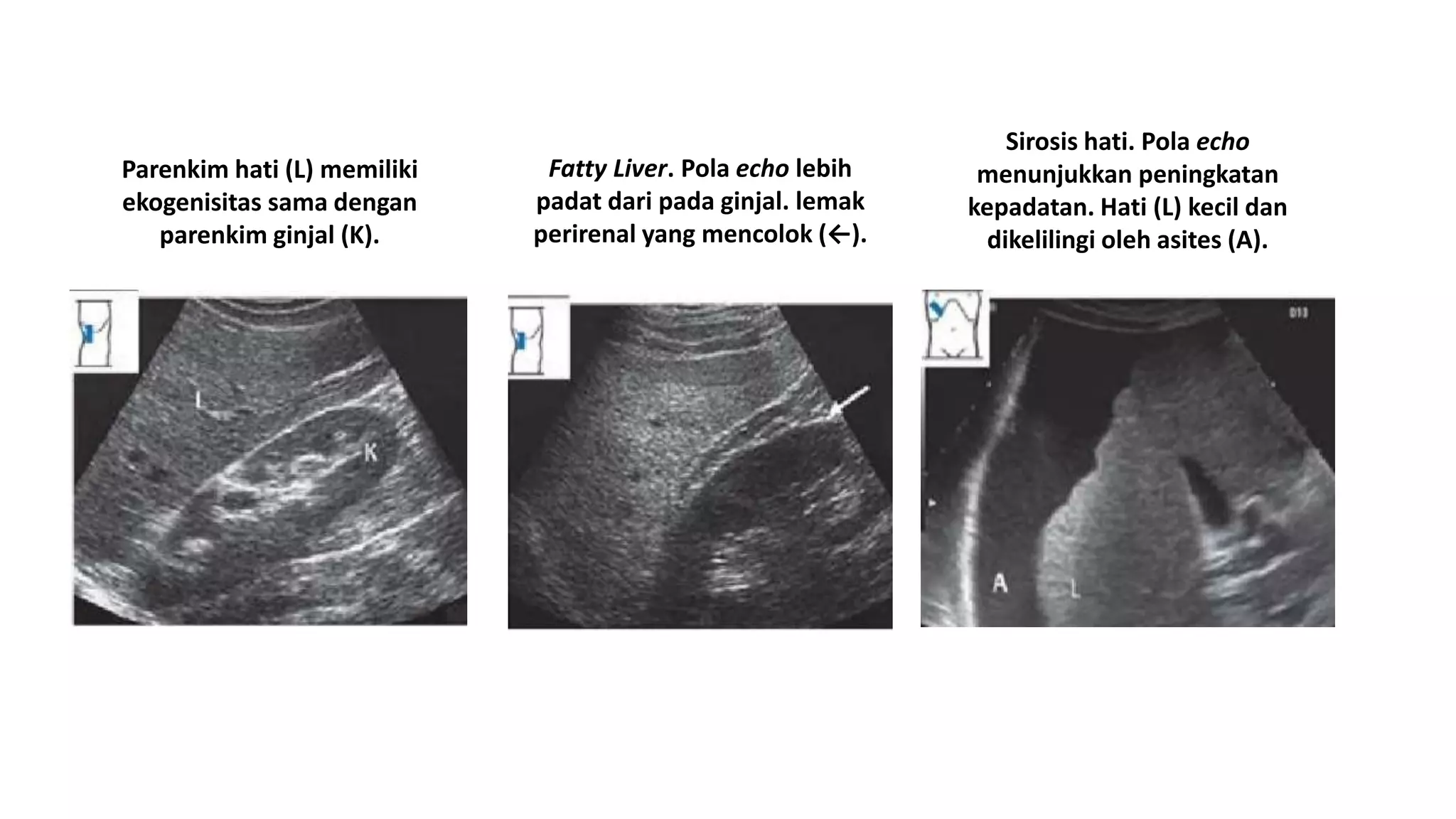 peran usg pada hepatobilier tugas reading gastro.pptx