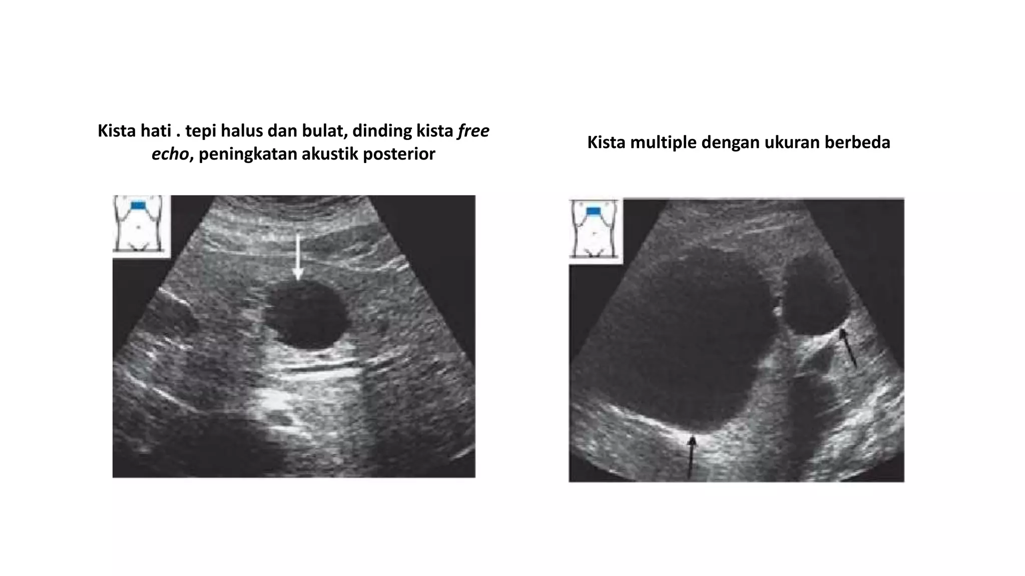 peran usg pada hepatobilier tugas reading gastro.pptx