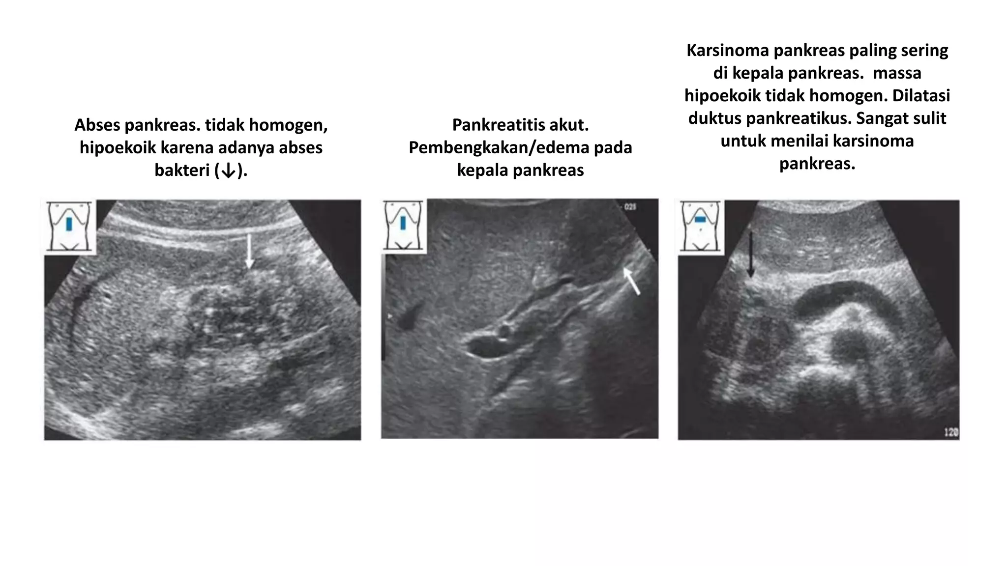 peran usg pada hepatobilier tugas reading gastro.pptx