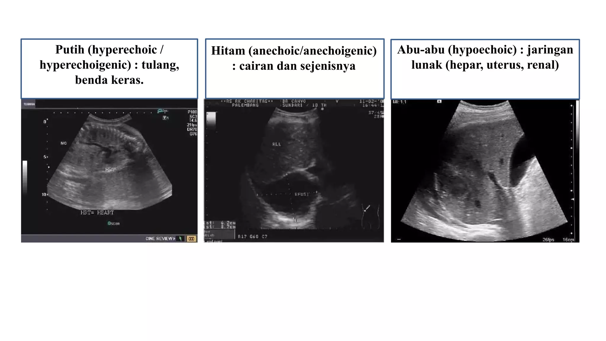 peran usg pada hepatobilier tugas reading gastro.pptx