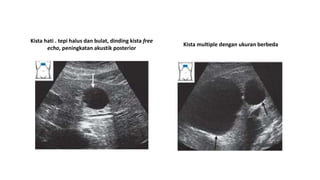 peran usg pada hepatobilier tugas reading gastro.pptx