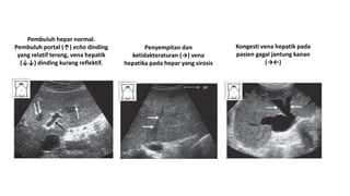 peran usg pada hepatobilier tugas reading gastro.pptx