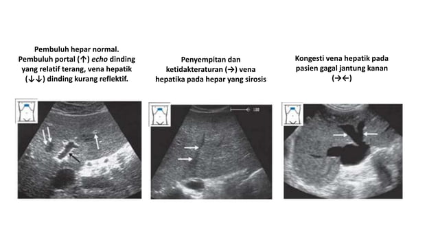 peran usg pada hepatobilier tugas reading gastro.pptx