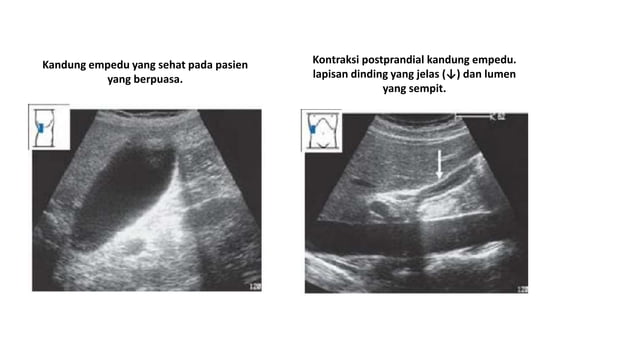 peran usg pada hepatobilier tugas reading gastro.pptx