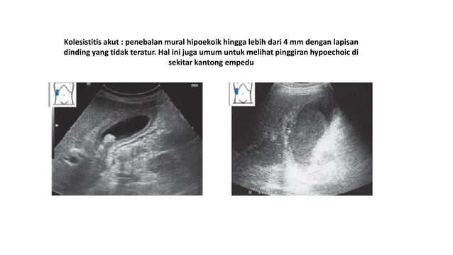 peran usg pada hepatobilier tugas reading gastro.pptx