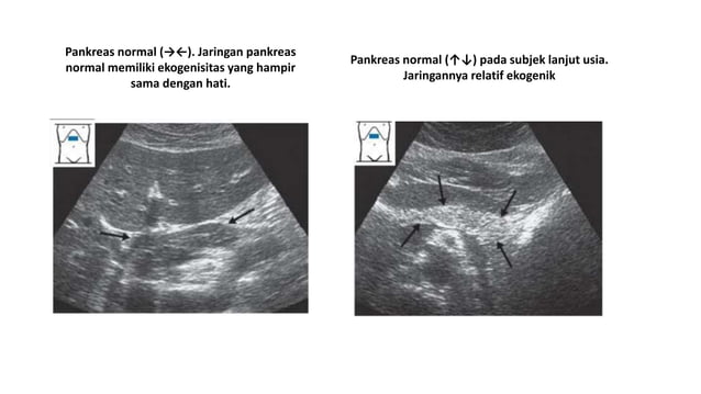peran usg pada hepatobilier tugas reading gastro.pptx