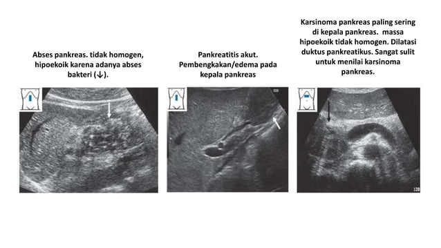 peran usg pada hepatobilier tugas reading gastro.pptx