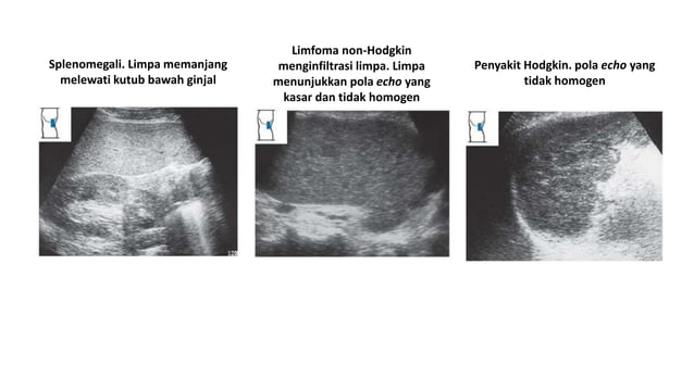 peran usg pada hepatobilier tugas reading gastro.pptx