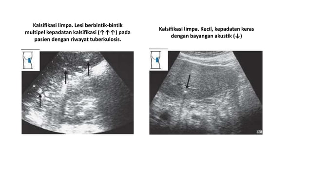 peran usg pada hepatobilier tugas reading gastro.pptx