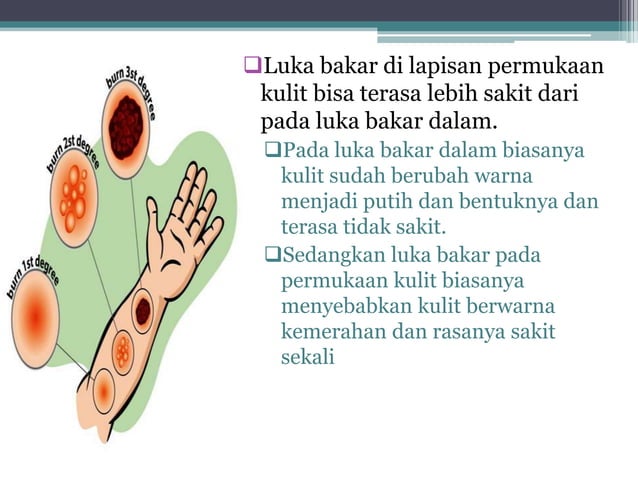Perawatan luka bakar | PPTX