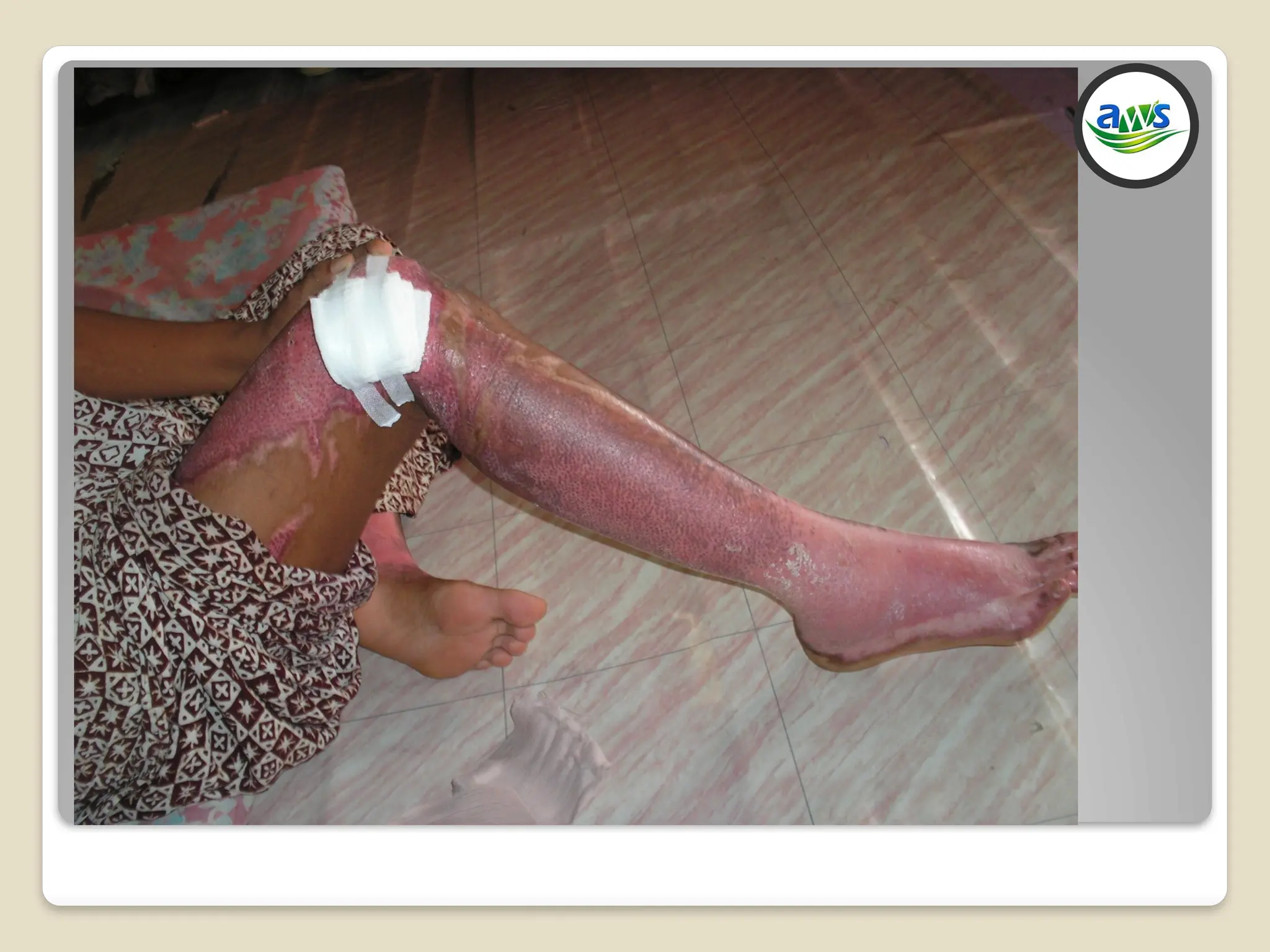 PELATIHAN PERAWATAN LUKA BAKAR MODERN AWS.pptx