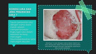 perawatan luka modern,terkini perbedaan perawatan luka konvensional | PPTX