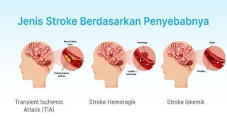 Perawatan pada pasien dengan stroke infark dan perdarahan.pptx
