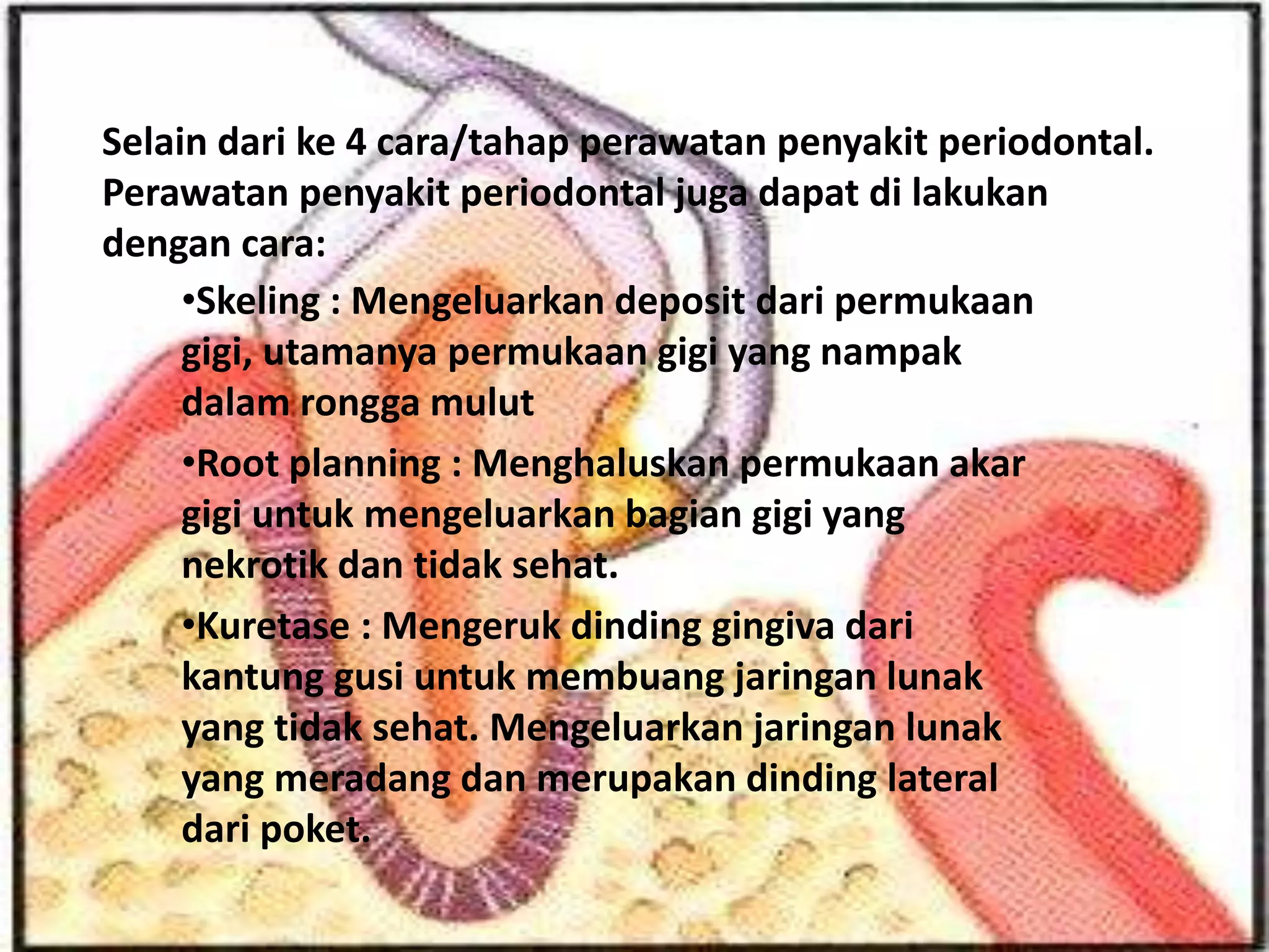 Perawatan penyakit periodontal | PPTX