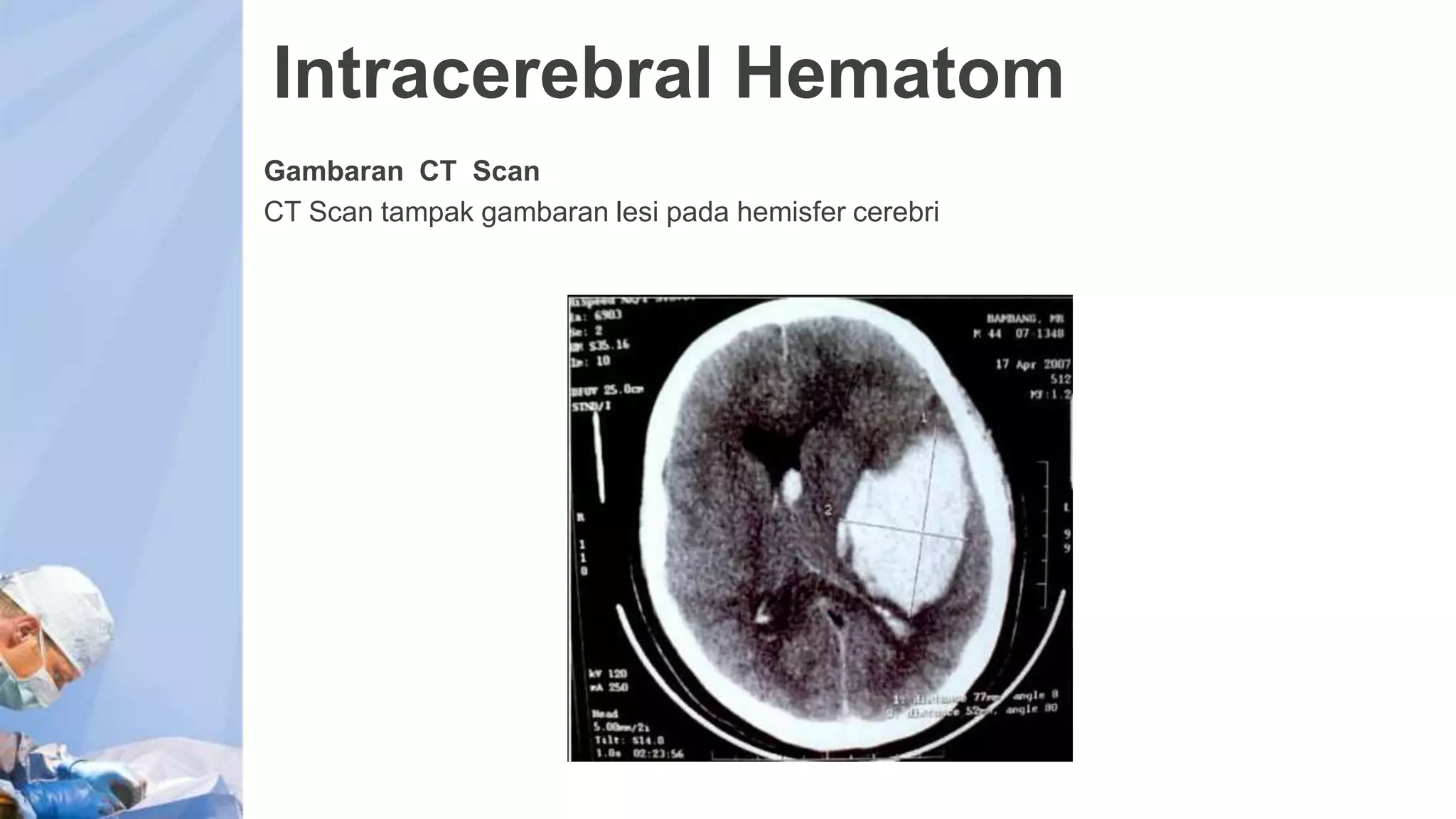 Perbedaan EDH SDH SAH ICH Berdasar CT Scan.pptx