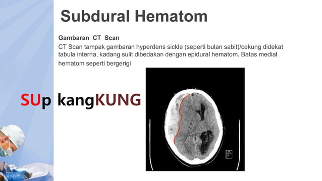 Perbedaan EDH SDH SAH ICH Berdasar CT Scan.pptx
