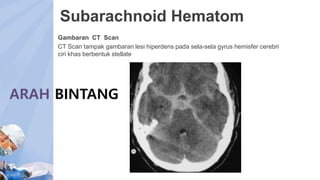 Perbedaan EDH SDH SAH ICH Berdasar CT Scan.pptx