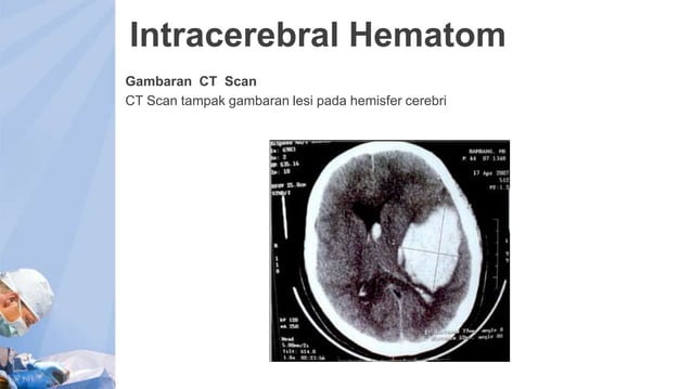 Perbedaan EDH SDH SAH ICH Berdasar CT Scan.pptx