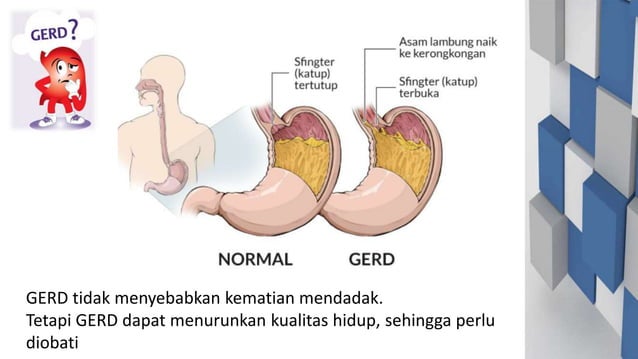 Perbedaan nyeri dada karena GERD atau penyakit jantung.pptx