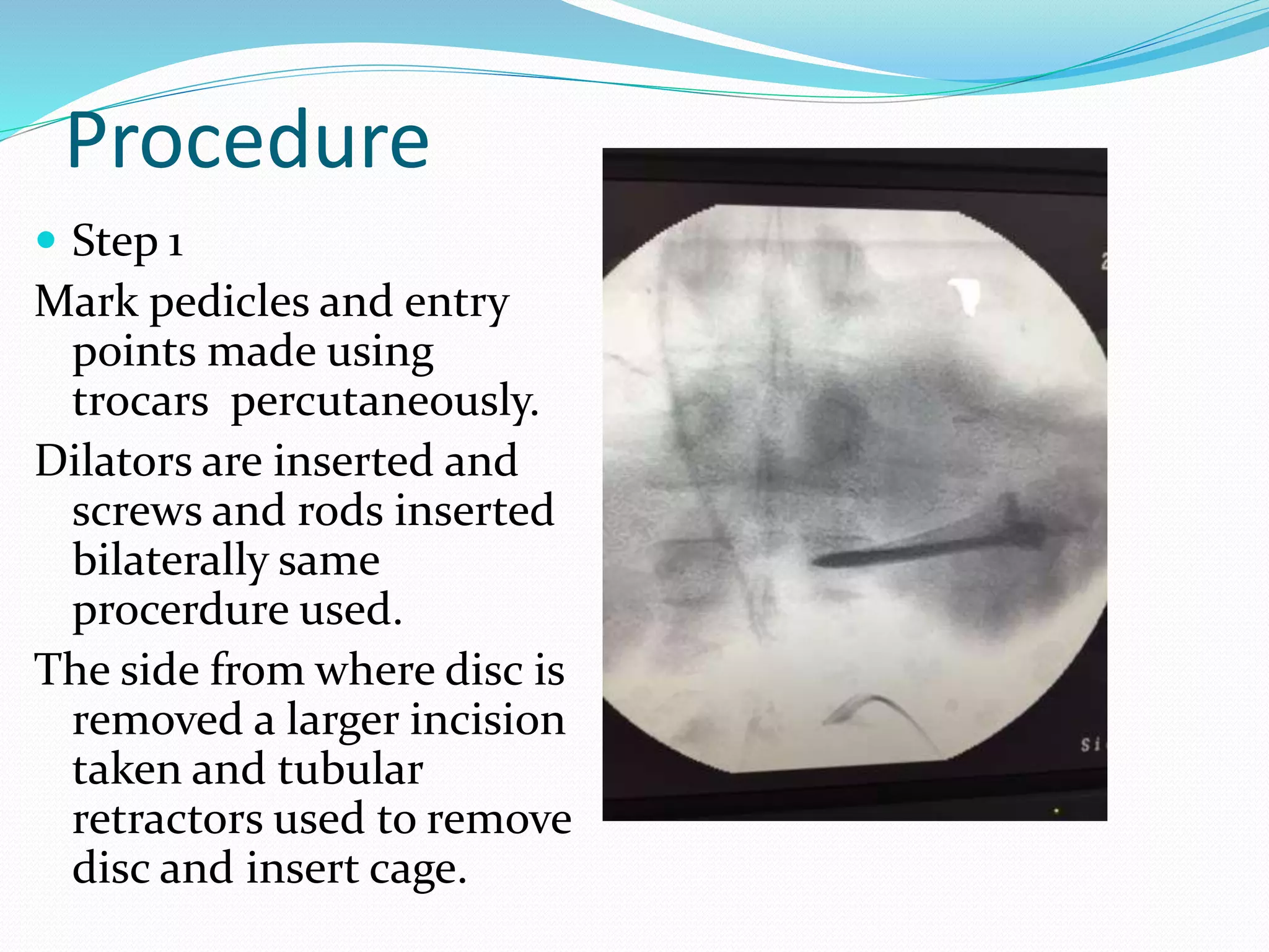 Percutaneous fixation-final | PPTX