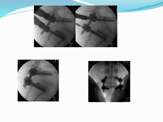 Percutaneous fixation-final | PPTX