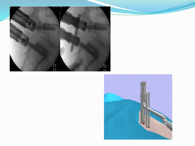 Percutaneous fixation-final | PPTX