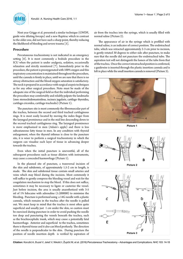 Percutaneous tracheostomy-advantages-and-complications-nhc-16-103 | PDF