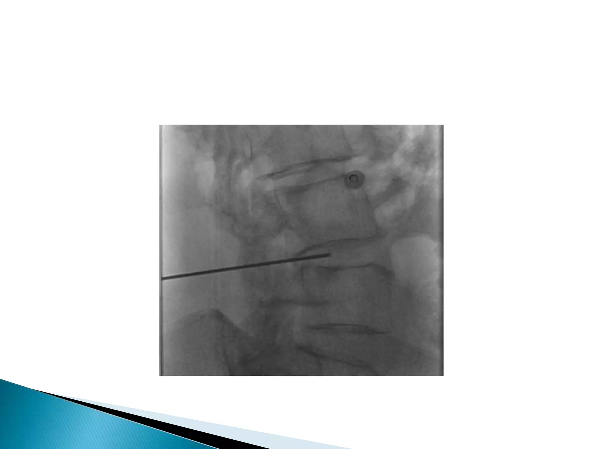 Percutaneous coblation disc nucleoplasty | PPTX