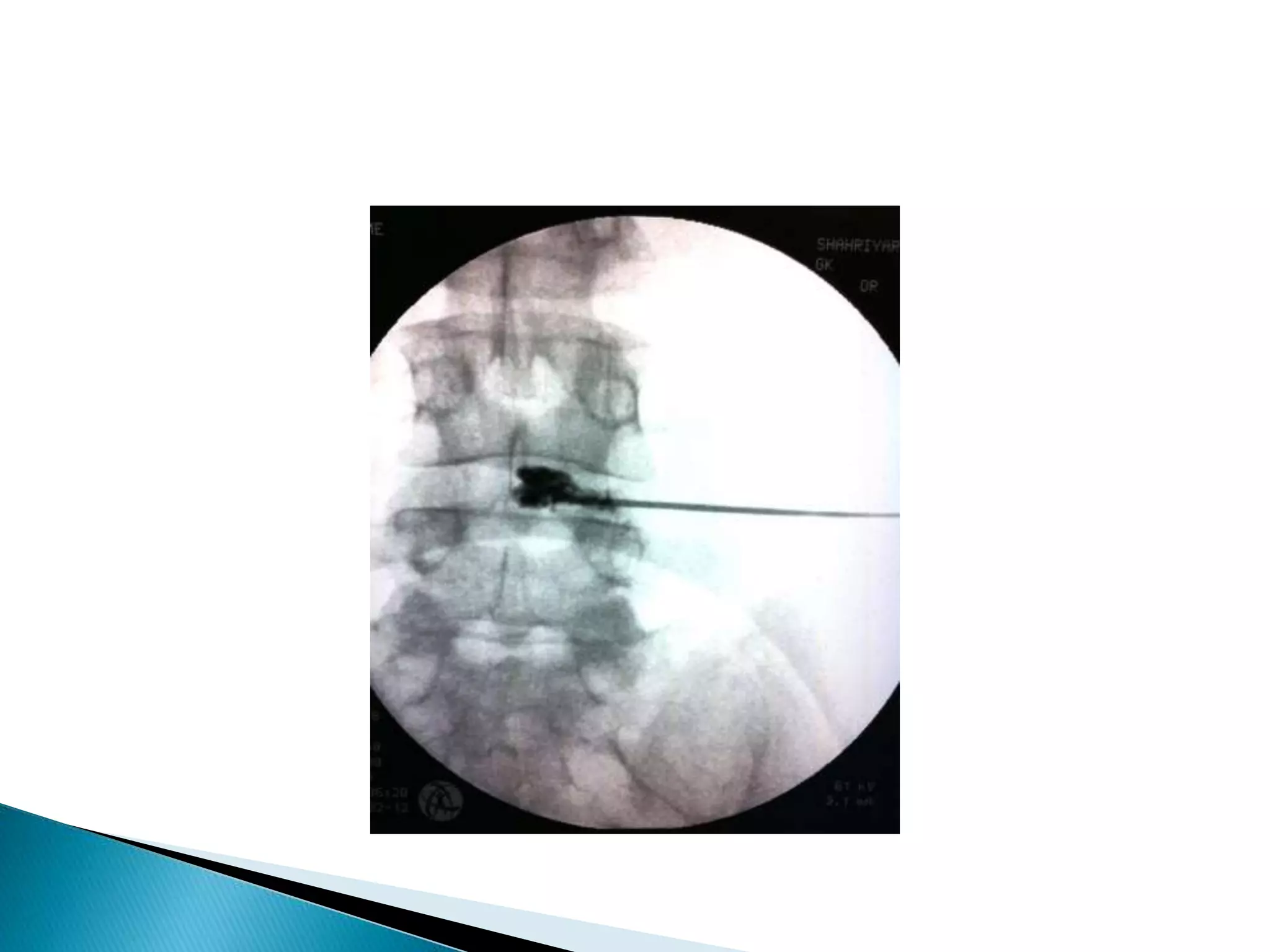Percutaneous coblation disc nucleoplasty | PPTX
